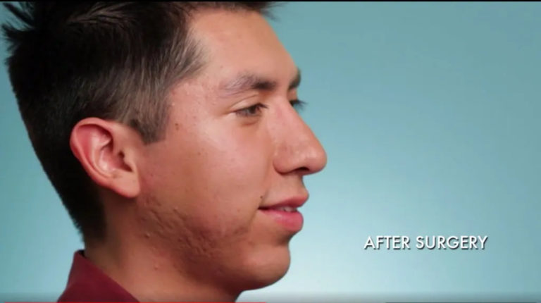 Dennis - Rhinoplasty Patient | Rawnsley Plastic Surgery